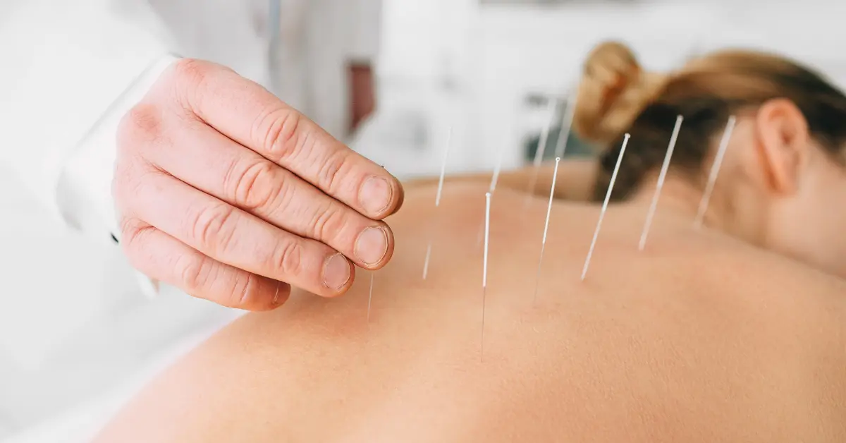Acupuncture (Needling Therapy): Benefits & Techniques