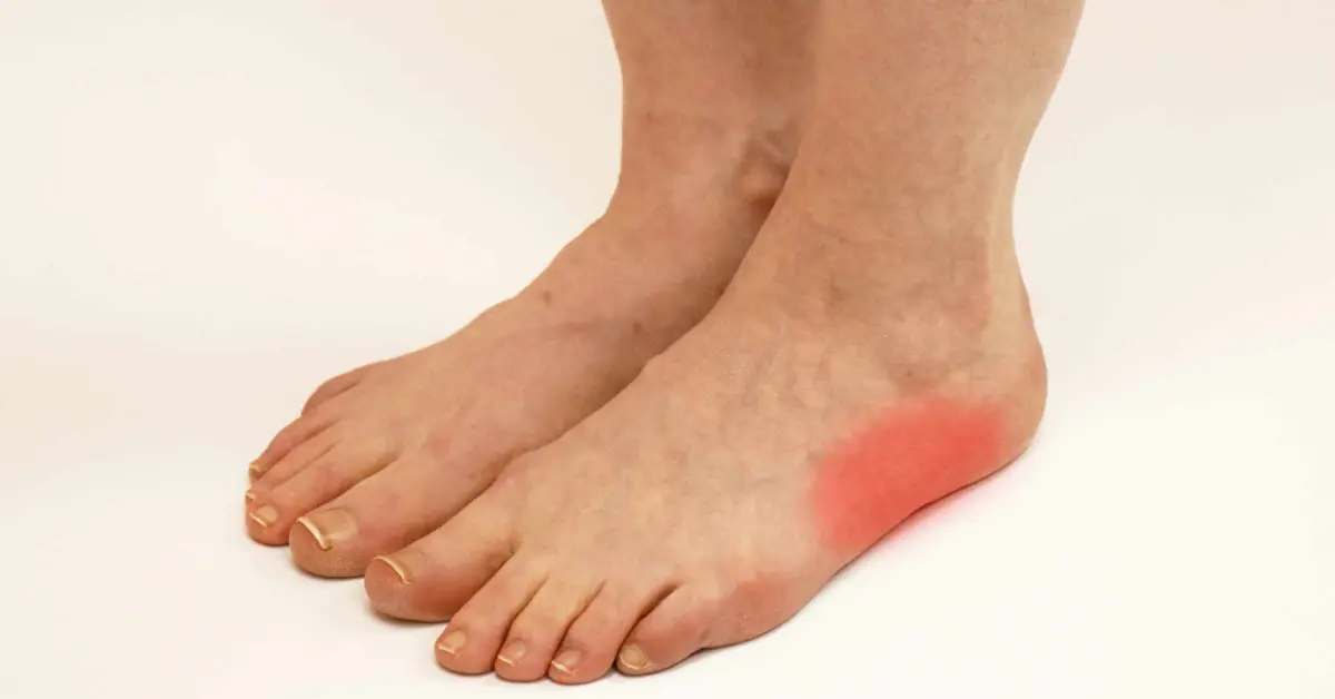 Cuboid Syndrome | Expert Care at Life Physiotherapy Clinic