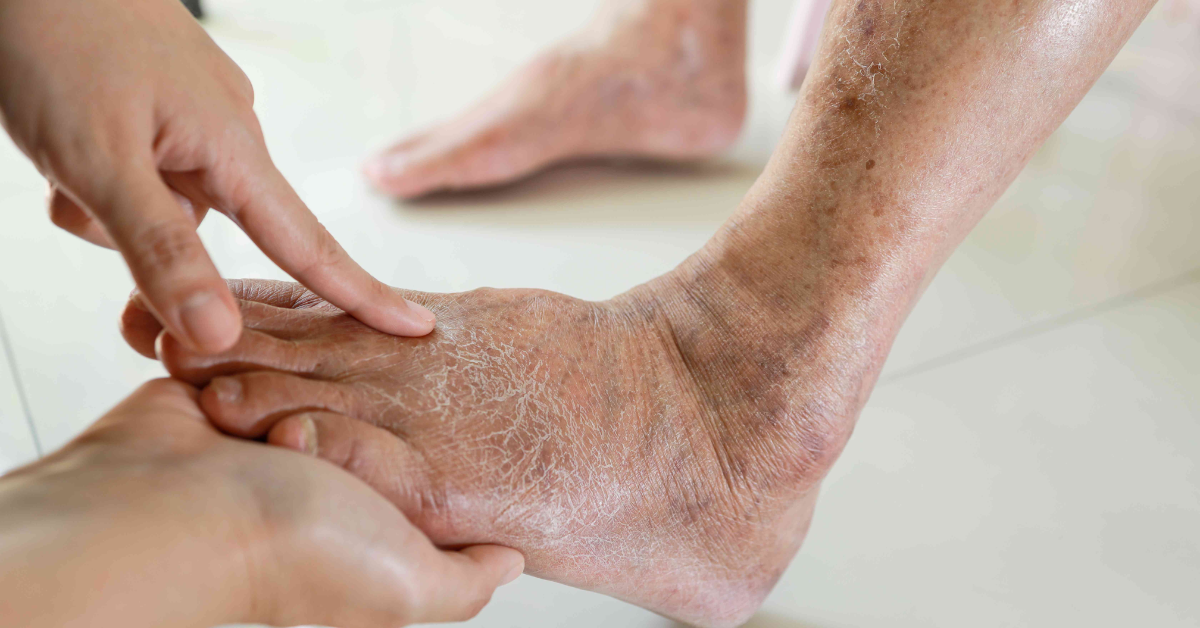 Diabetic Foot Care | Life Physiotherapy Clinic
