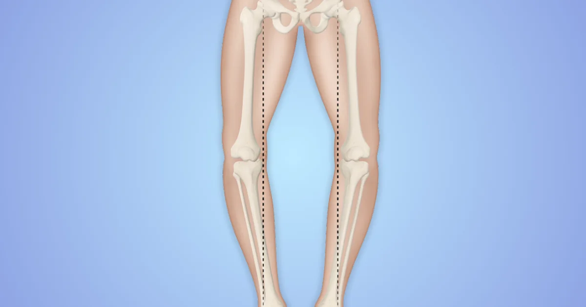 Genu Varum - Life Physiotherapy Clinic