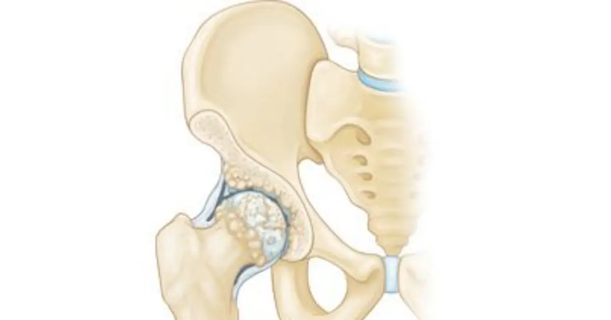 Hip Osteoarthritis - Life Physiotherapy Clinic