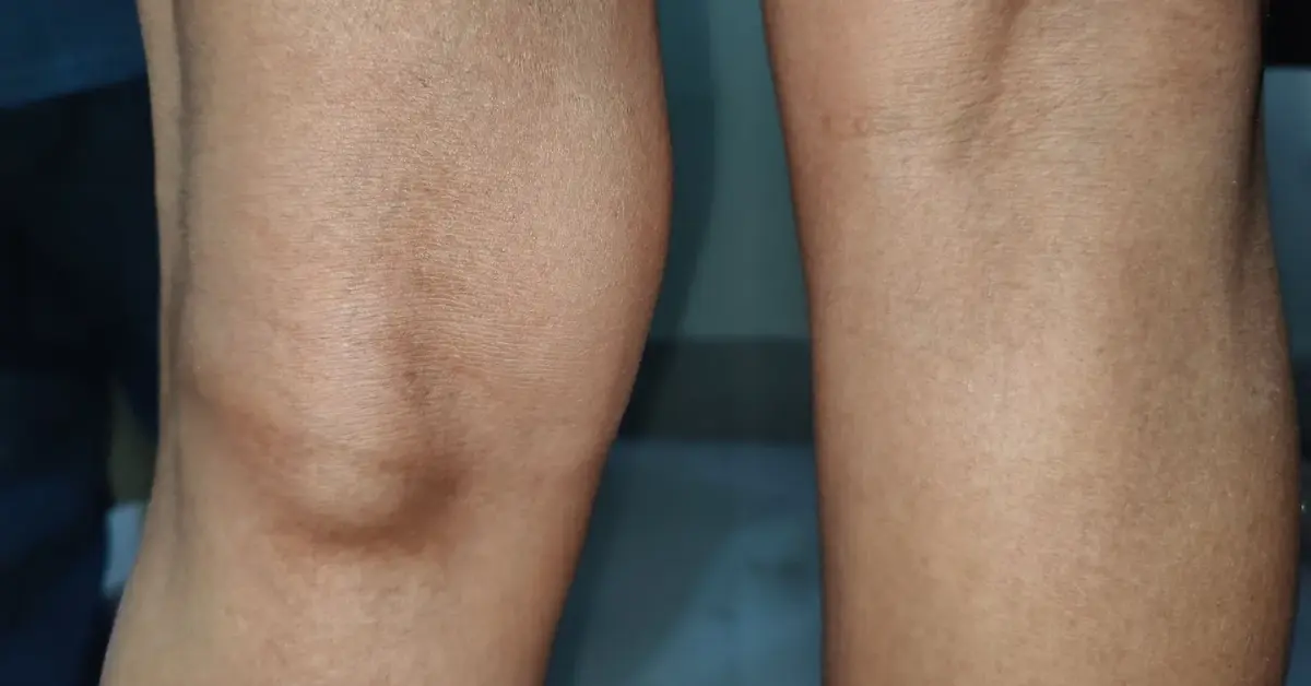 Popliteal (Baker's) Cyst - Life Physiotherapy Clinic
