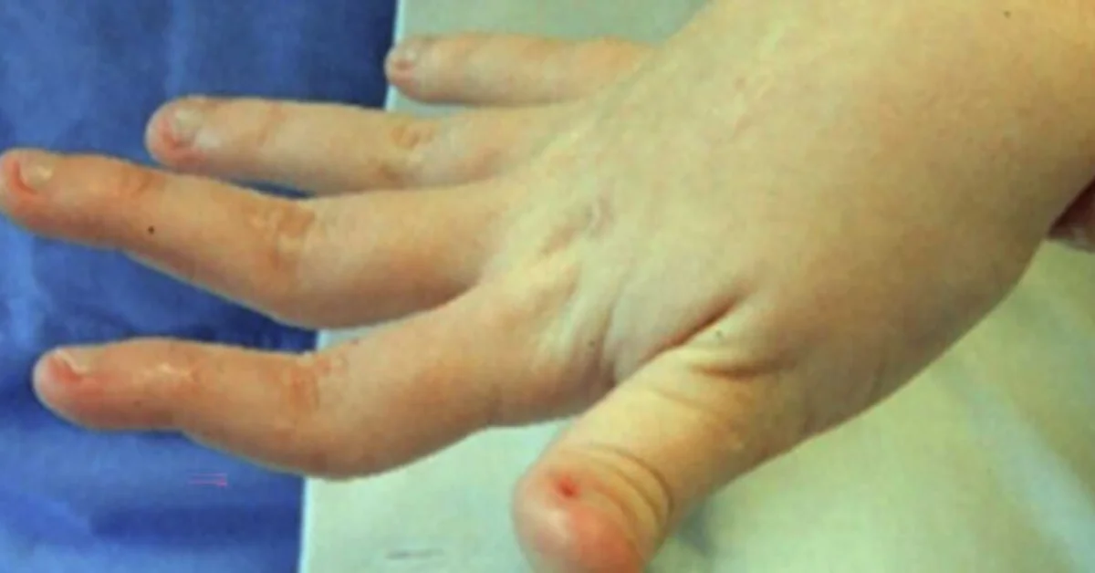 Swan Neck Deformity - Life Physiotherapy Clinic