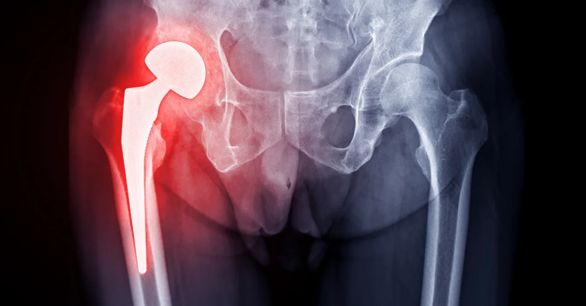 Total Hip Replacement (THR) - Life Physiotherapy Clinic